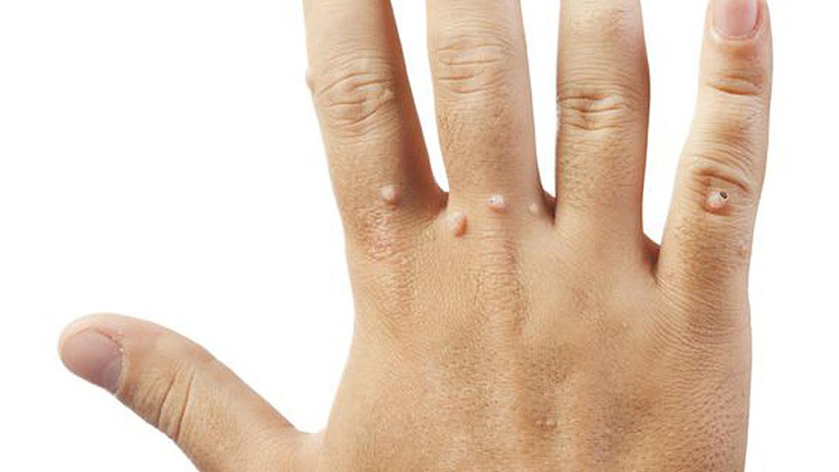 12 Cara Menghilangkan Kutil Secara Alami, Cepat dan Ampuh