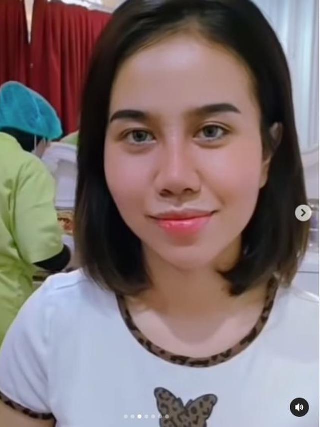 8 Potret Perubahan Wajah Mayang Usai Operasi Hidung, Sudah Lepas Perban ...