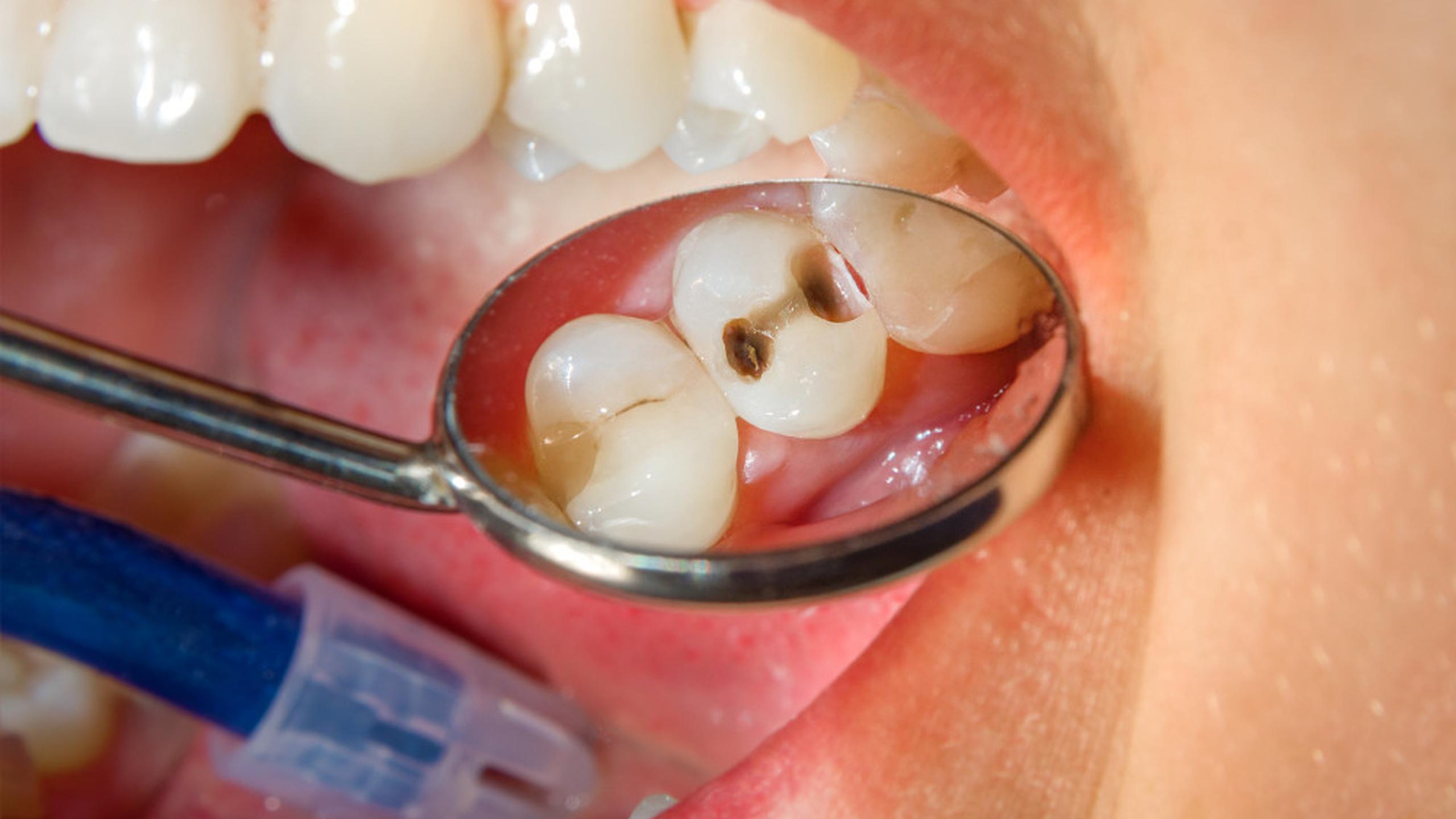 Sakit Gigi Tak Tertahankan? Ini Panduan Lengkap Matikan Saraf Gigi ...