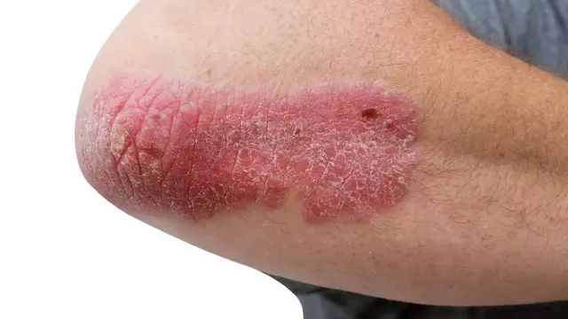 17 Jenis Gatal pada Kulit dan Gambarnya, Umum Diderita Semua Usia - Hot ...