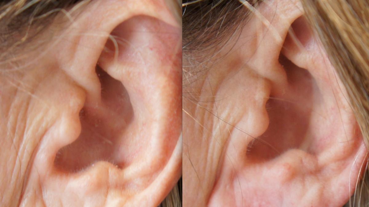 Bahaya Mengintai di Balik Keriput di Telinga - Health Liputan6.com