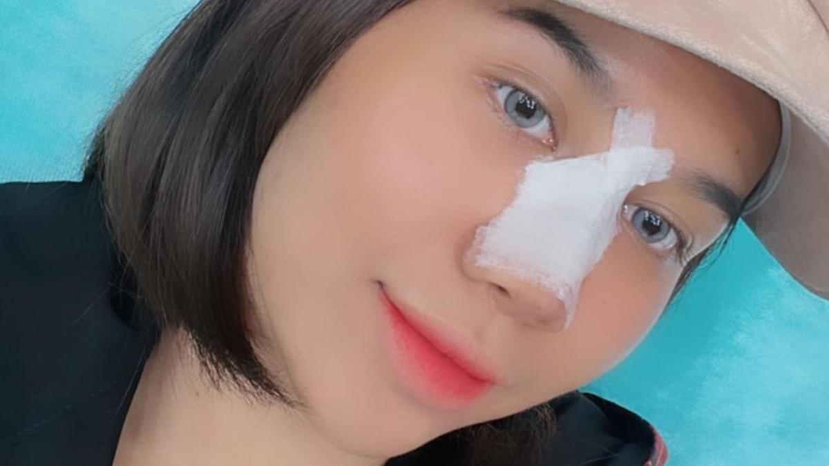 Potret Mayang Lucyana Lepas Perban Usai Operasi Plastik di Bagian Hidung