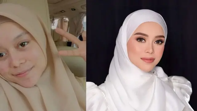 15 Transformasi Artis Sebelum Dan Sesudah Suntik Botoks Ada Yang