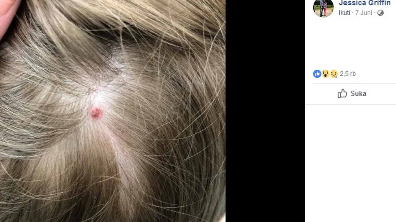 Digigit Kutu, Gadis 5 Tahun Ini Lumpuh - Health Liputan6.com