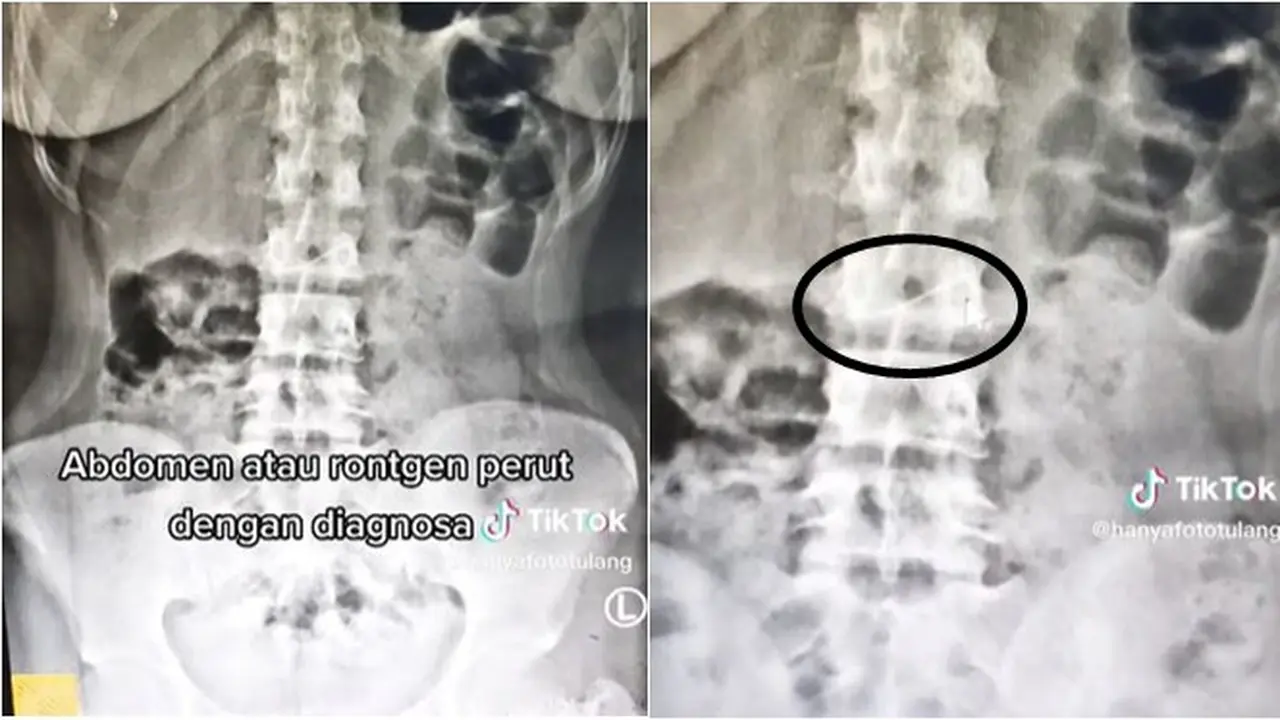 Wanita Ini Tak Sengaja Telan Jarum Pentul saat Pakai Hijab, Tertancap ...