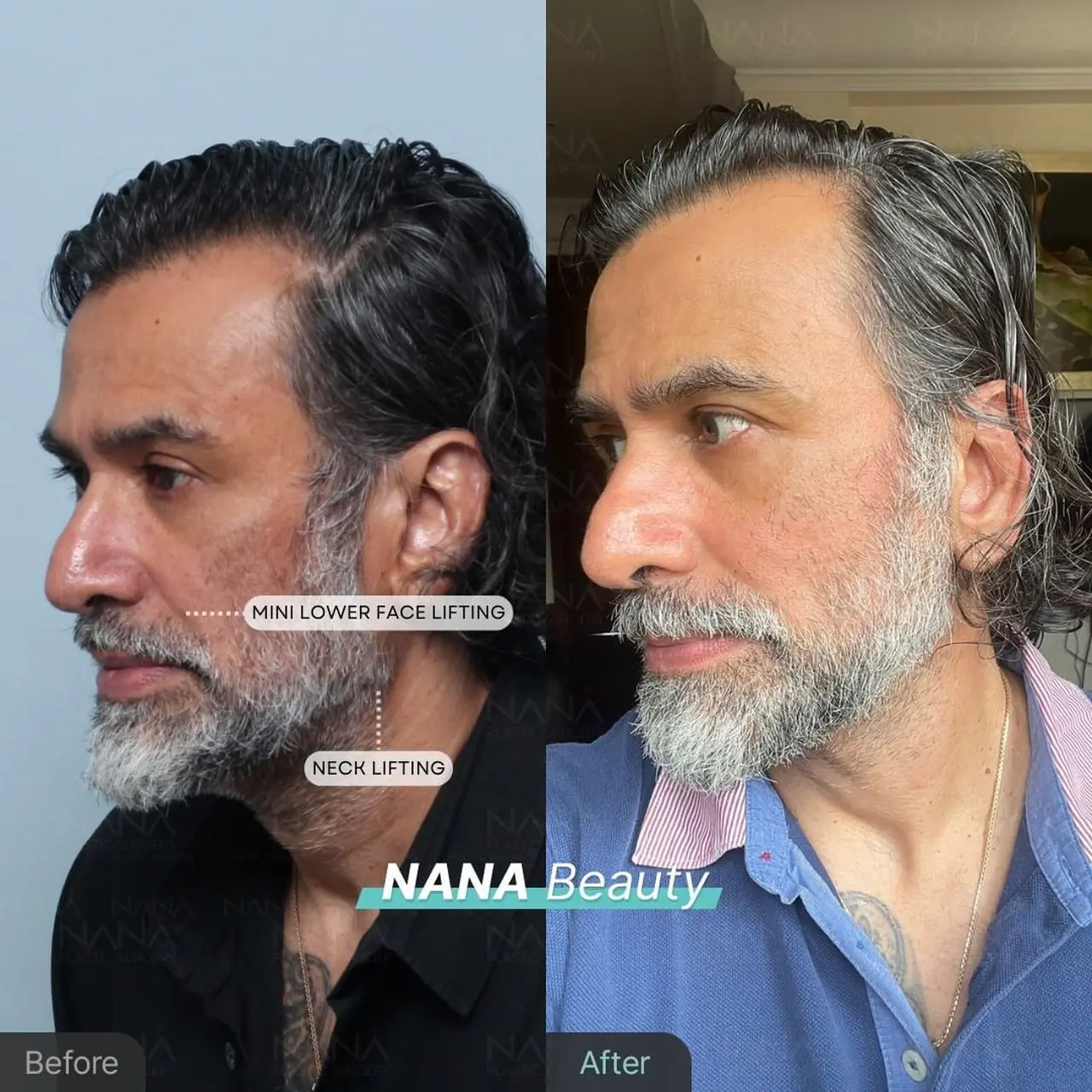 10 Potret Jeremy dan Ina Thomas Jalani Operasi Plastik di Korea, Jadi ...