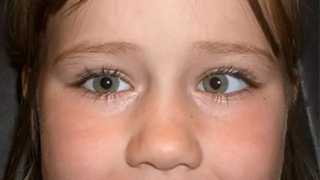 Penyebab dan Penanganan Mata Juling pada Anak, Panduan Lengkap untuk ...