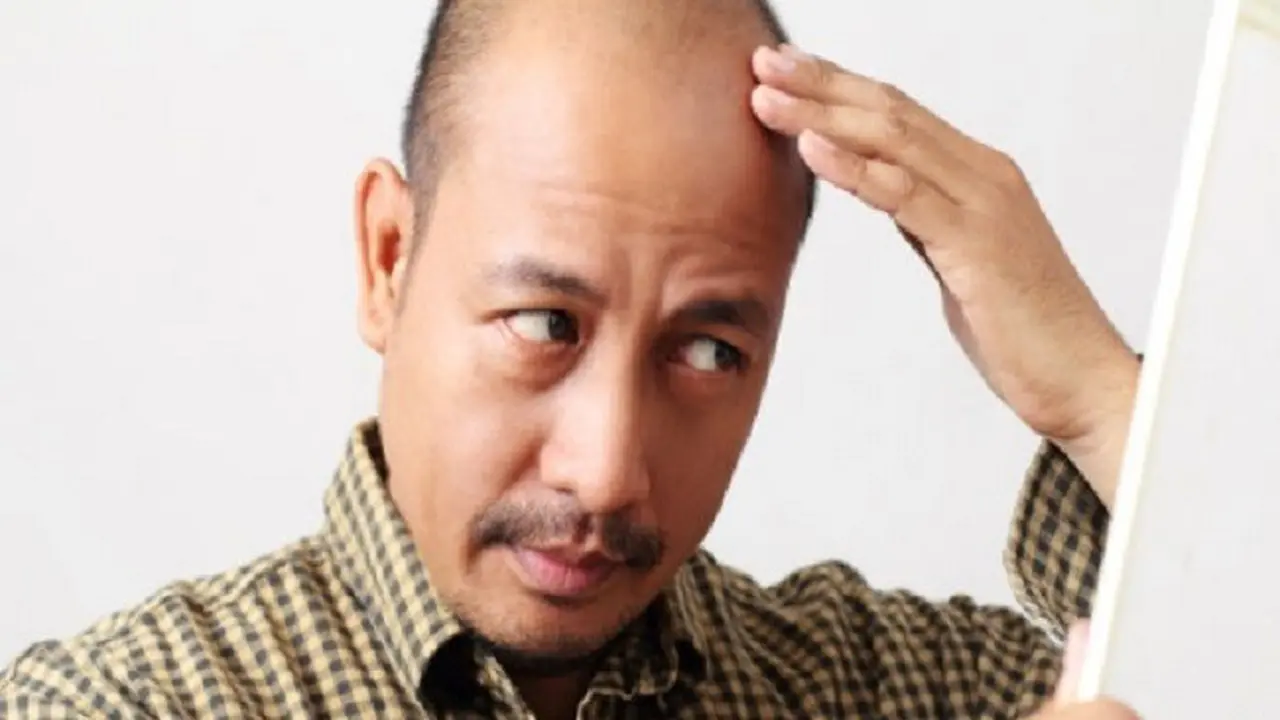 5 Fakta tentang Kebotakan pada Pria - Fashion & Beauty Liputan6.com