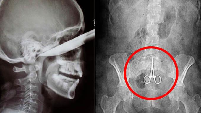 10 Foto Rontgen Dengan Benda 'Aneh' Dalam Tubuh - Lifestyle Fimela.com