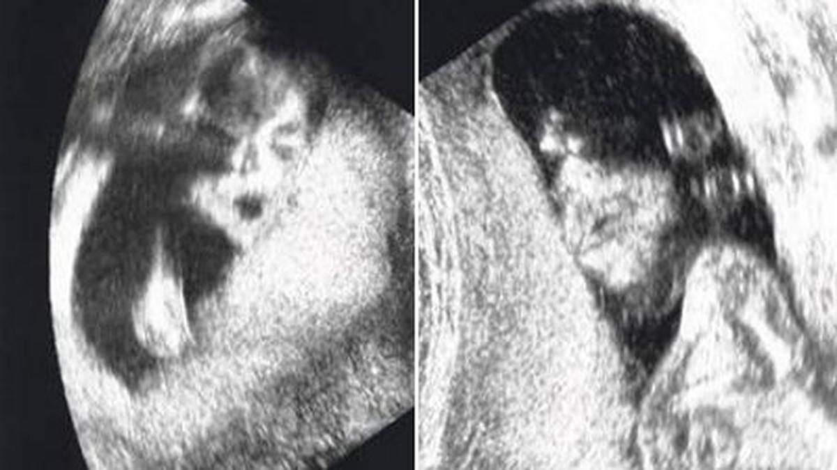 Top 5 Health: Foto USG yang Bikin Pembaca Tercengang - Health Liputan6.com