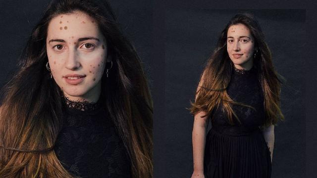 Punya 500 Tanda Lahir, Gadis Ini Tumbuh Jadi Sosok Tak Terduga - Hot ...