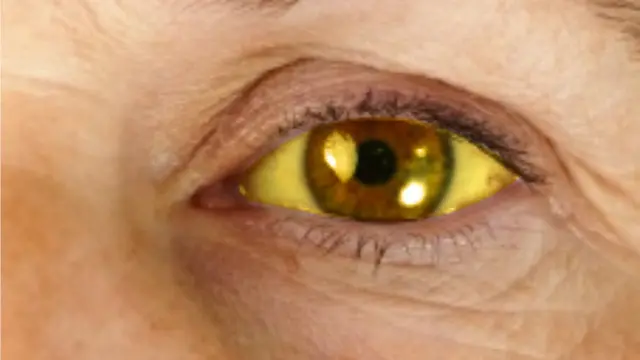 Mengenal Penyakit Kuning, Simak Seberapa Berbahaya dan Bagaimana ...