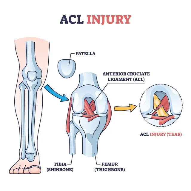 Cedera ACL, Kenali Gejala, Cara Mencegah, dan Cara Mengatasinya - Health Liputan6.com