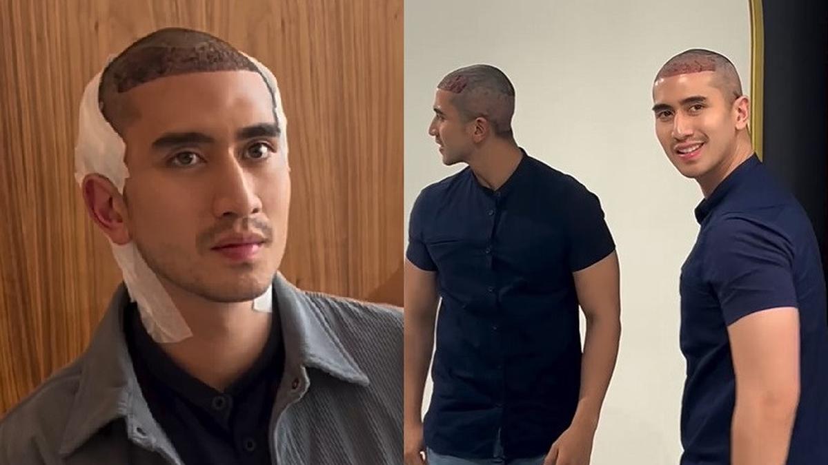 Proses Verrel Bramasta Lakoni Tanam Rambut, Dibotakin dan Digambar Dulu ...