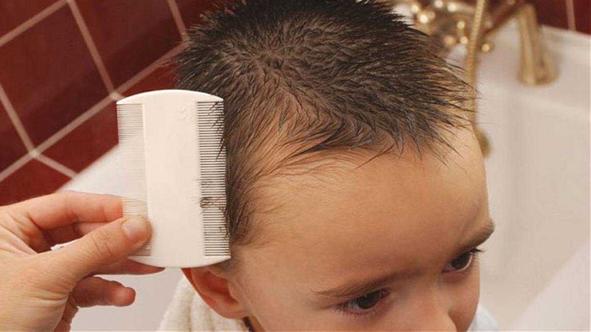 3 Fakta tentang Kutu Rambut yang Orangtua Perlu Tahu - Health Liputan6.com