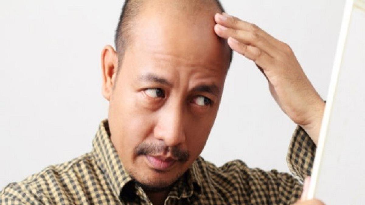 5 Fakta tentang Kebotakan pada Pria