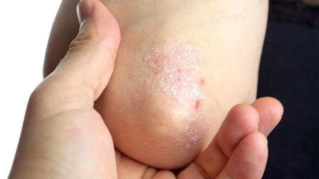 Apa Itu Penyakit Psoriasis Vulgaris? Berikut Gejala dan Penyebabnya