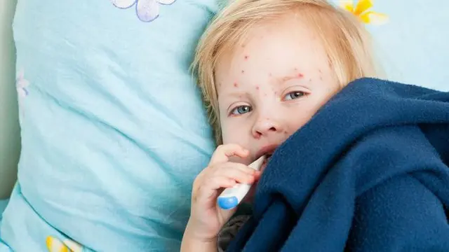 Morbili Adalah Penyakit Infeksi Menular, Kenali Gejala dan Penyebabnya ...