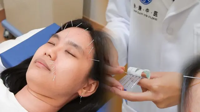 Mengenal Teknik Pengobatan Tradisional Tiongkok - Regional Liputan6.com