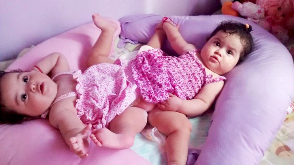 Bayi Kembar Siam Dempet Panggul Akhirnya Terpisah - Health Liputan6.com