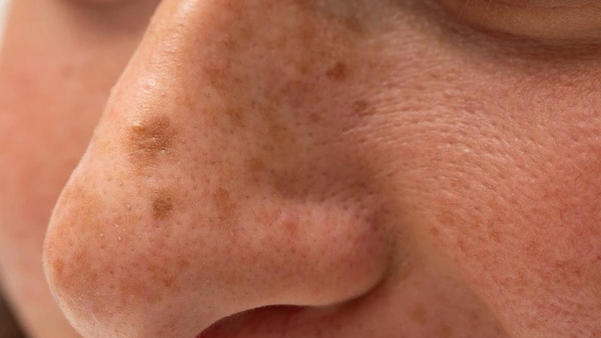 Mengenal Tanda Tahi Lalat di Hidung, Dari Sisi Medis hingga Perspektif ...