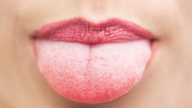 Lidah Putih Tanda Apa? Kenali Arti Warna, Penyebab dan Cara Mengatasinya