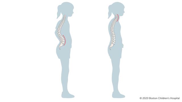 Lordosis Adalah Melengkungnya Tulang Leher atau Punggung Bawah, Ini ...