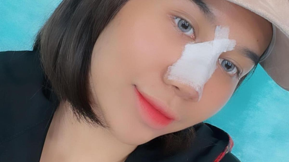 6 Potret Before-After Mayang Adik Vanessa Angel Operasi Hidung, Makin ...