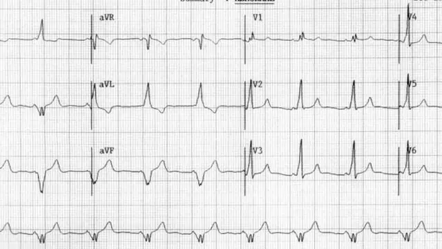 EKG Adalah Pemeriksaan Rekam Jantung, Begini Fungsi dan Prosedur Penggunaannya - Hot Liputan6.com