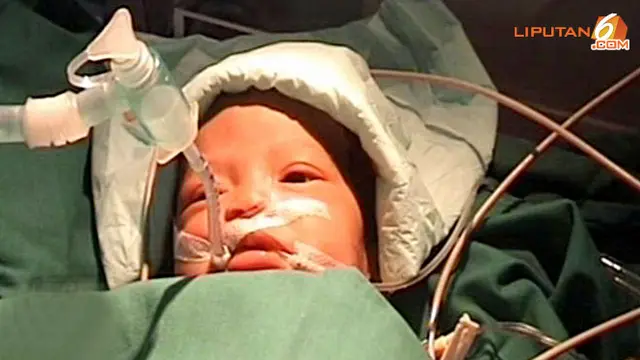 VIDEO: Bayi Kembar Siam Ponorogo Berhasil Dipisahkan - Health Liputan6.com