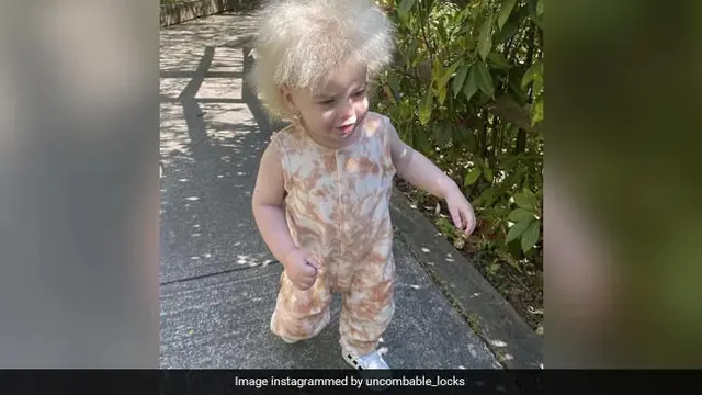 Mirip Albert Einstein, Rambut Bocah Ini Idap Kondisi Langka Tak Bisa ...