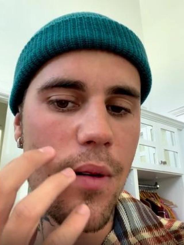 Kenali Ramsay Hunt Syndrome, Kelumpuhan Wajah yang Didera Justin Bieber ...