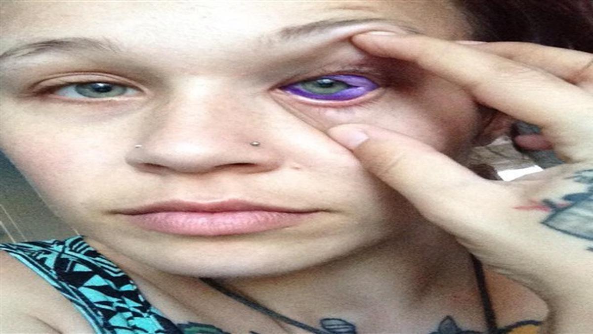 Akibat Tato pada Bola Mata, Catt Terancam Buta - Health Liputan6.com