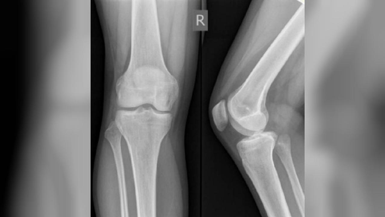 Rontgen Adalah Proses Diagnosis dengan Radiasi Sinar-X, Simak Prosedur ...