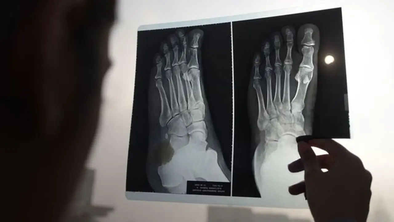 Rontgen Adalah Proses Diagnosis dengan Radiasi Sinar-X, Simak Prosedur ...