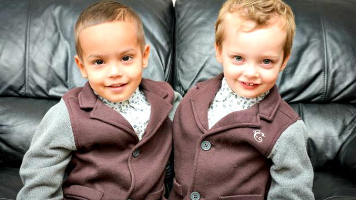 Bobby dan Riley, Kembar Langka di Dunia - Global Liputan6.com