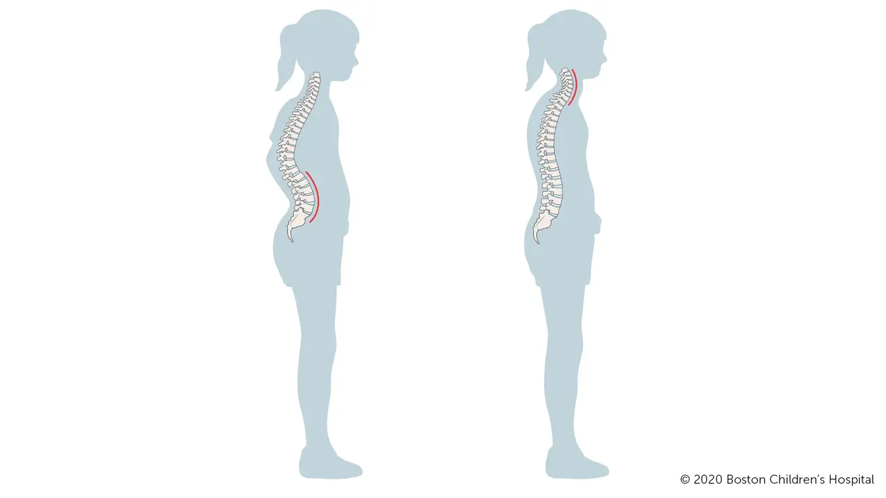 Lordosis Adalah Melengkungnya Tulang Leher atau Punggung Bawah, Ini ...