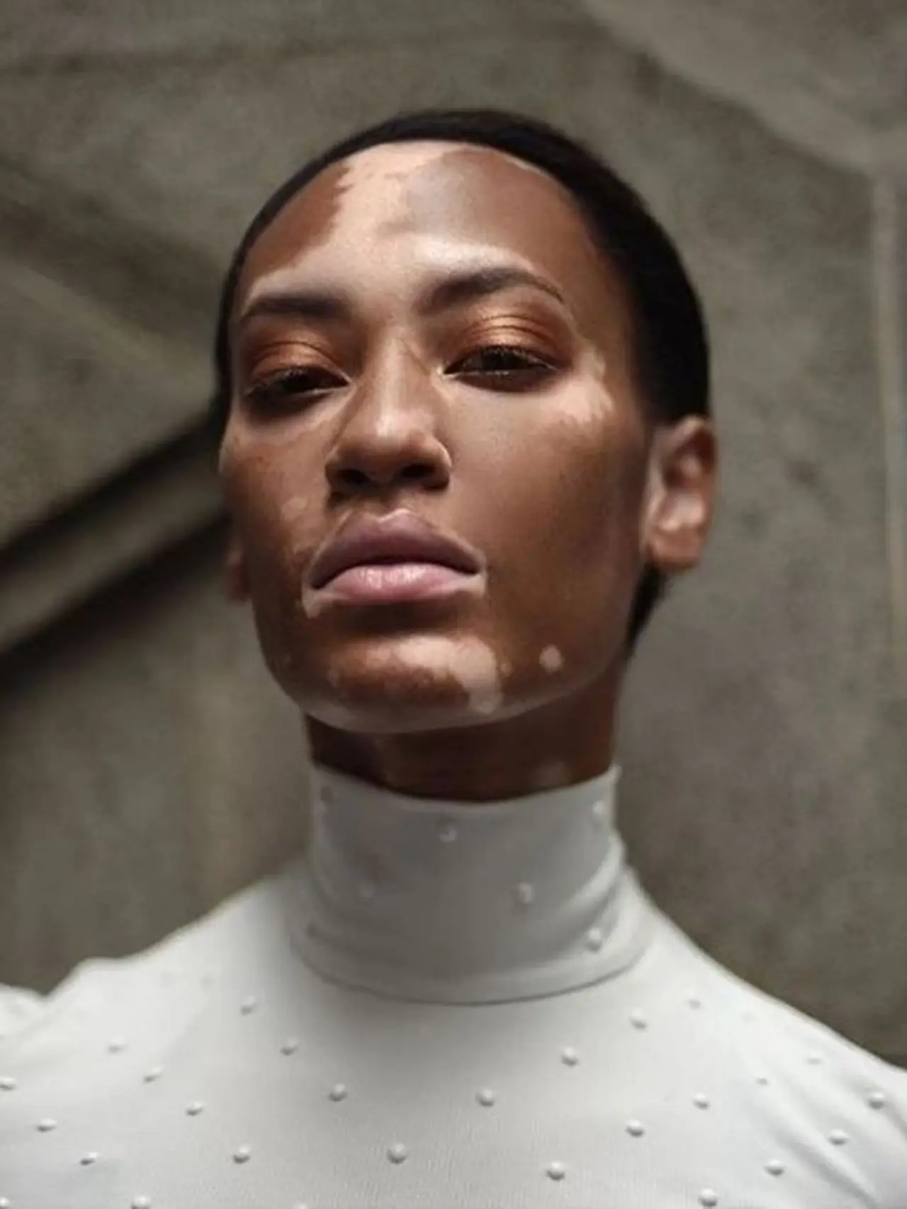 Menderita Vitiligo, Amy Deanna Berhasil Jadi Model yang Mendunia