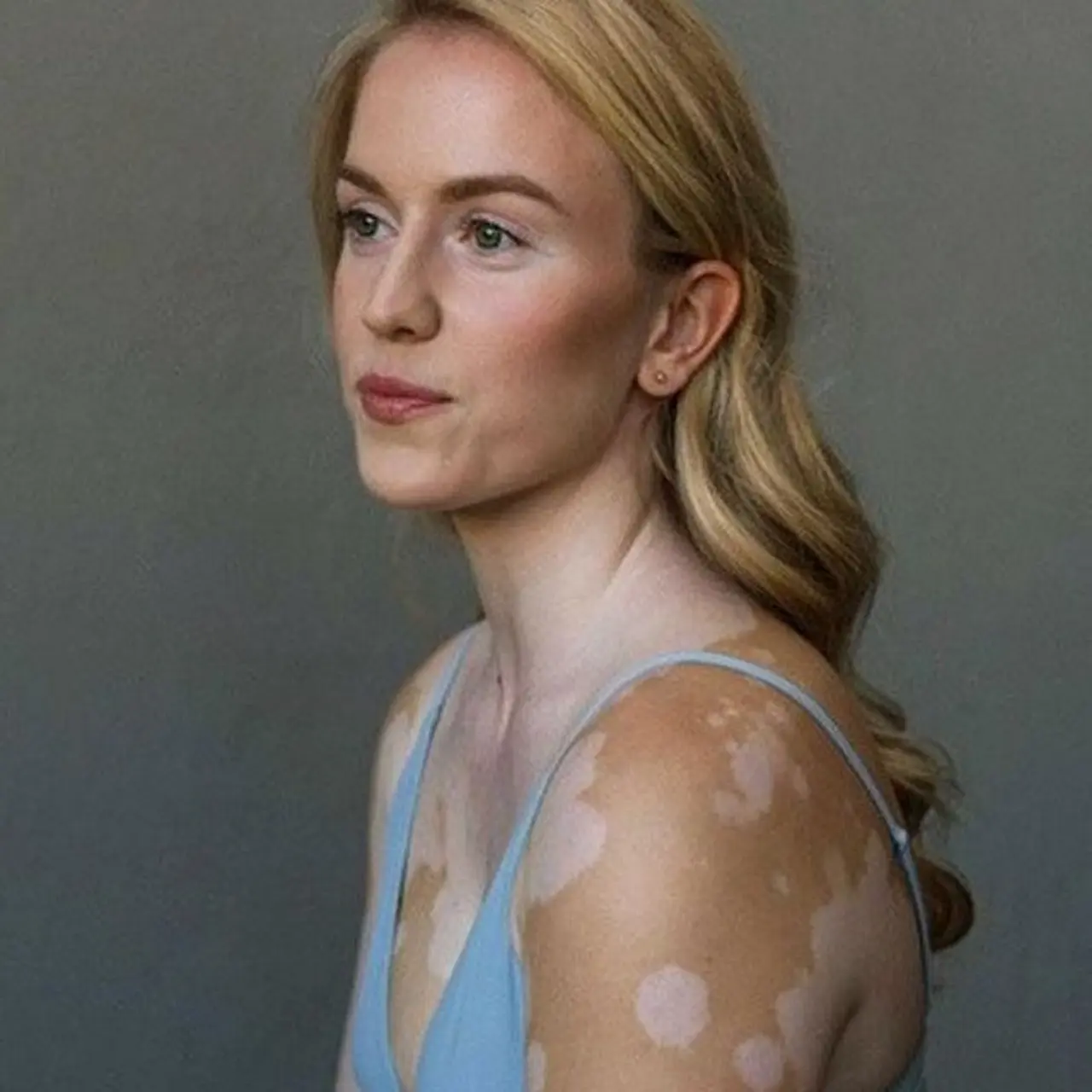 Fotografer Abadikan Potret Tubuh Pengidap Vitiligo, Hasilnya Bikin ...