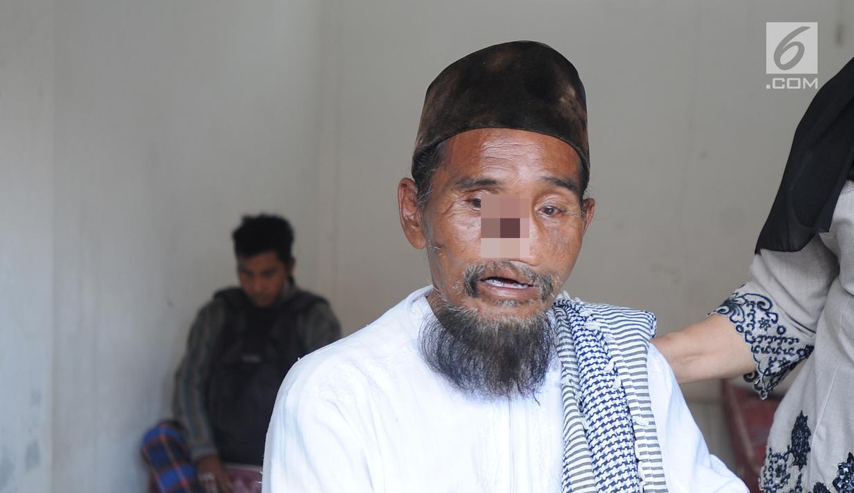 FOTO: Viral Bermobil, Pengemis Tanpa Hidung Diamankan Satpol PP di Bogor
