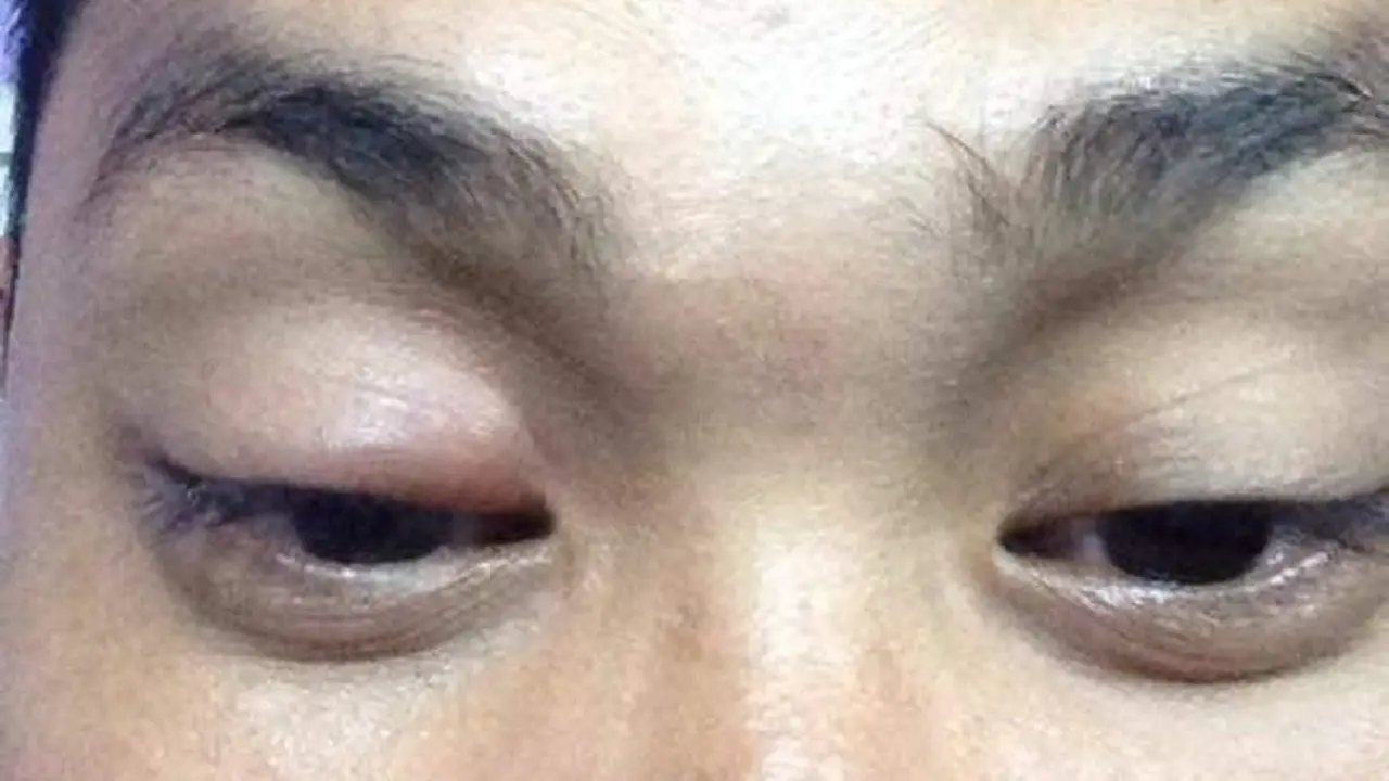Penyebab Mata Bintitan, Gejala, dan Cara Mengobatinya yang Pelu ...