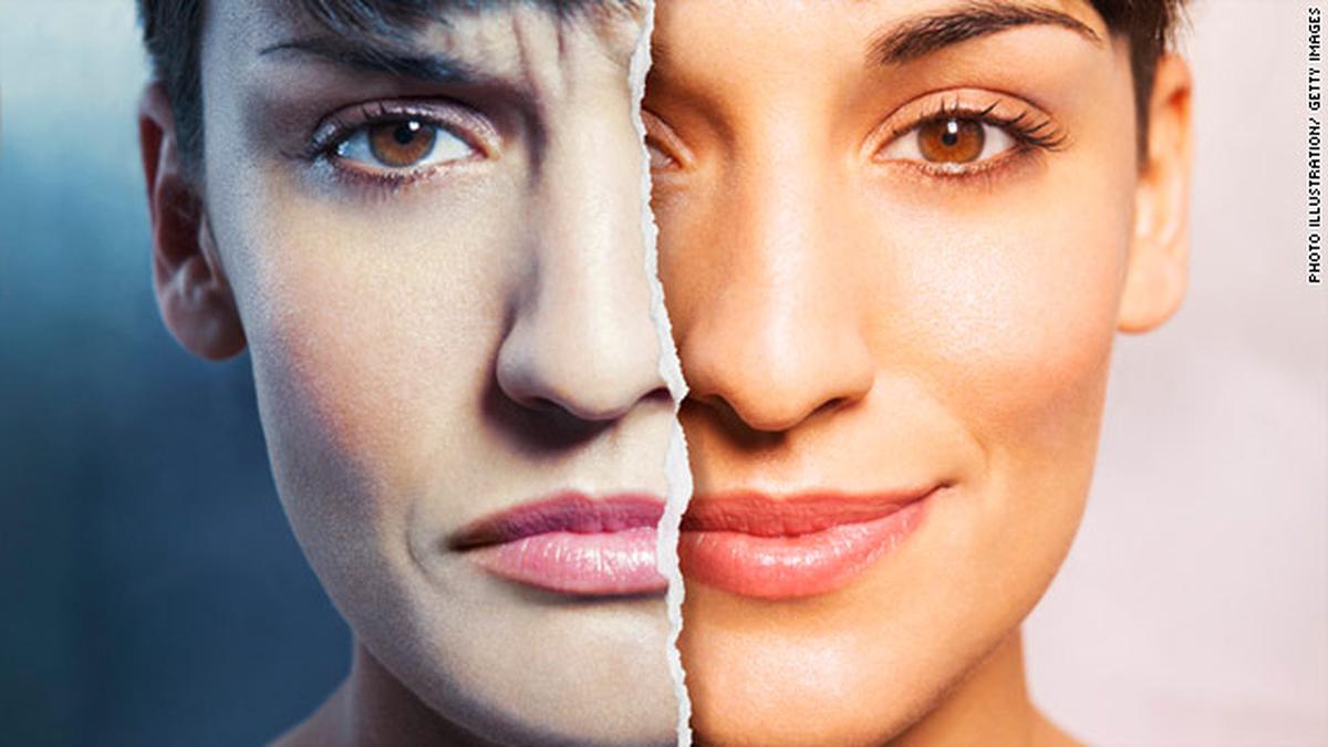 Kenapa Bipolar Bisa Menimpa Marshanda? - Health Liputan6.com