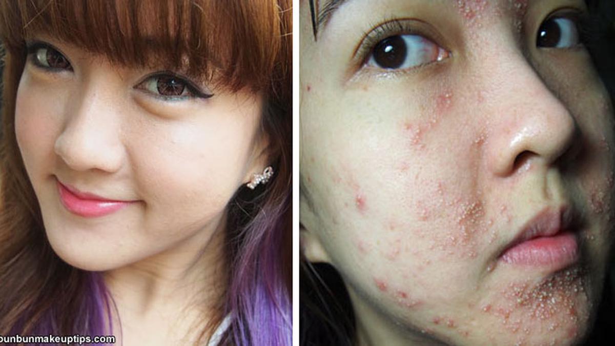 Bukannya Cantik, Muka Juli Makin Parah dan Bernanah Usai `Nyalon`