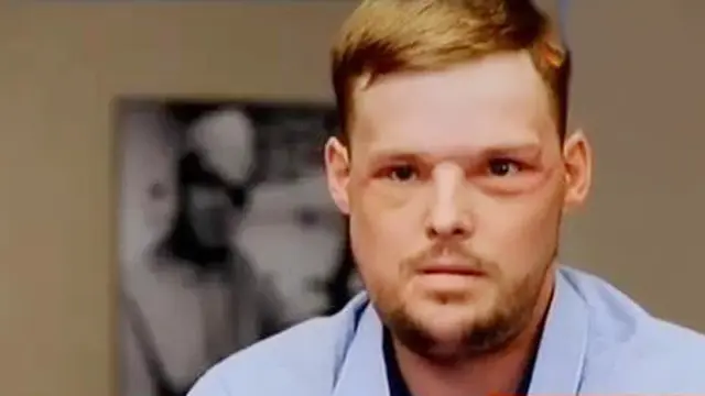 VIDEO: Andy Sandness, Pasien yang Sukses Miliki Wajah Baru - TV ...