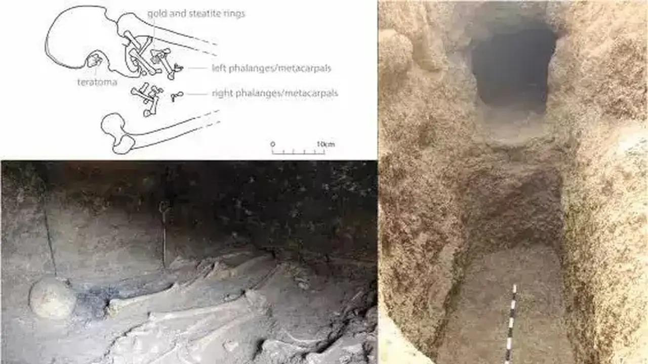 Tumor Bergigi Ditemukan di Panggul Wanita Mesir Kuno, Ini Penampakannya ...