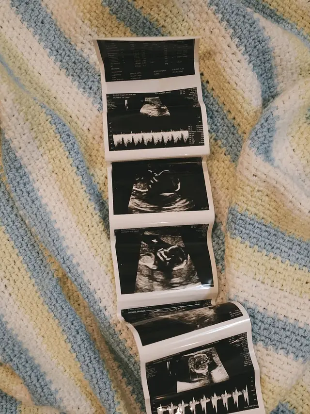 Anggika Bolsterli Hamil Anak Pertama, Unggah Foto USG Hingga Banjir ...