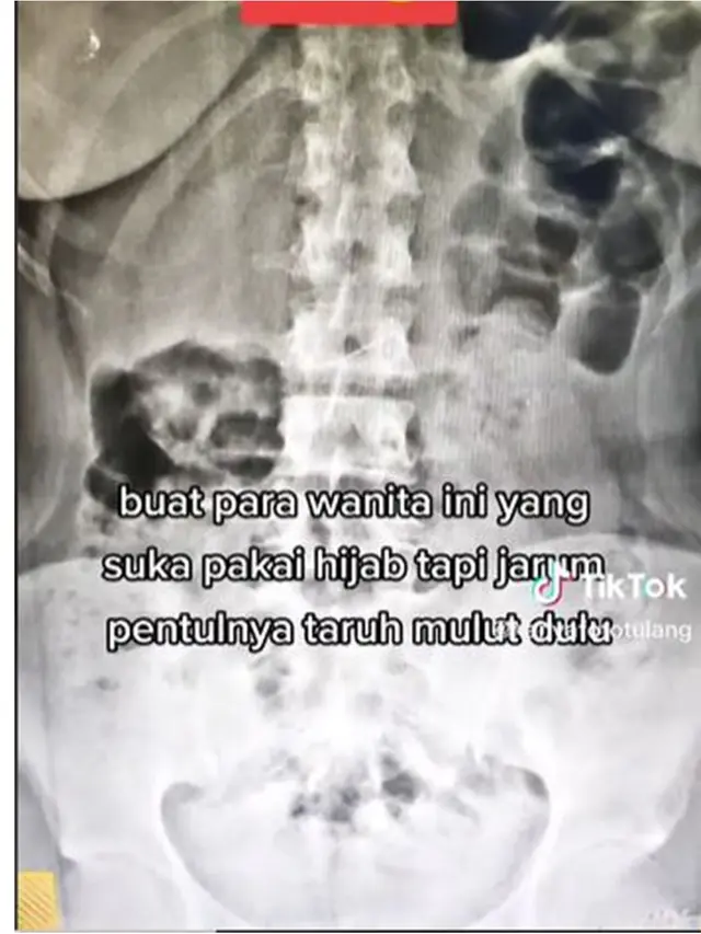 Wanita Ini Tak Sengaja Telan Jarum Pentul saat Pakai Hijab, Tertancap ...