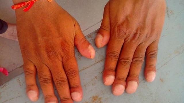 Telinga Kusut hingga Kuku Gepeng, 6 Tanda Tak Biasa Penyakit Jantung ...