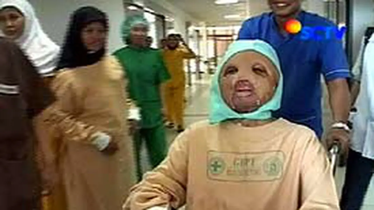 Lisa Akan Dipindahkan ke Unit Luka Bakar - News Liputan6.com