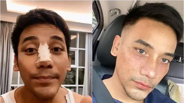 Termasuk Deddy Corbuzier, Perubahan Dagu 5 Artis Pria Ini Jadi Sorotan ...